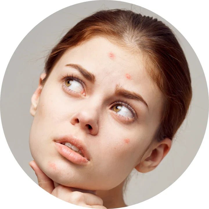 Acne – U16 Ultimate Beauty